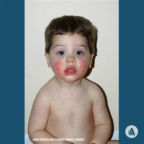 Erythema Infectiosum Parvovirus B19 Cdc Warns Of New Slapped Cheek