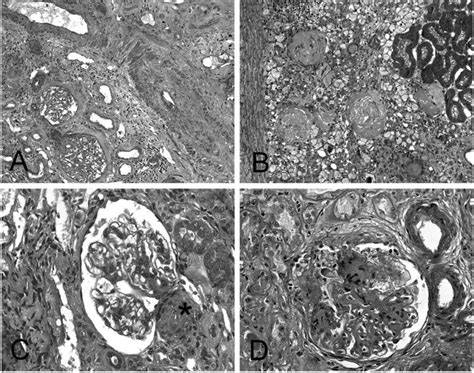Renal Histopathologic Lesions A Arterial Lesions The Majority Of