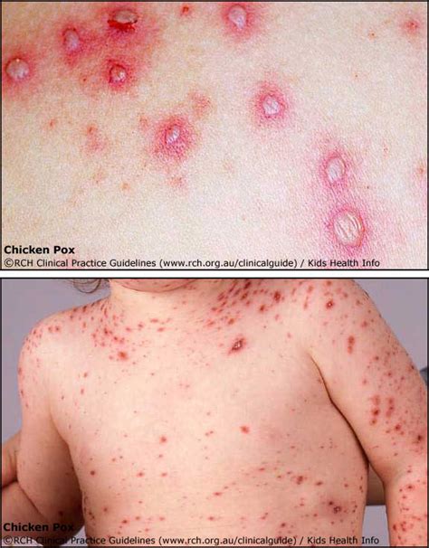 Chicken Pox Pictures Eczema Free Skin