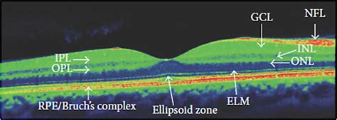 Inflammation And Dme Roundtable Discussion Retinal Physician