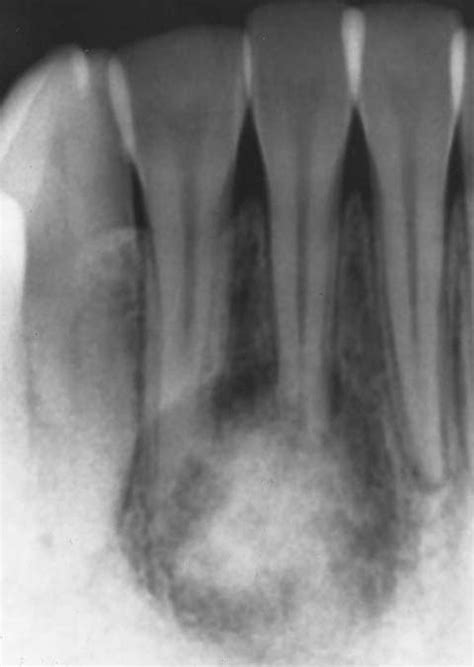 Osteoid Osteoma Jaw