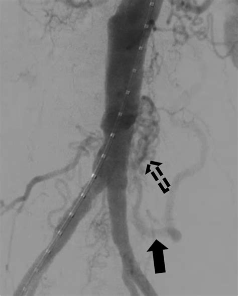 Endovascular Aneurysm Repair With Mesenteric Artery Bypass For An Abdominal Aortic Aneurysm With