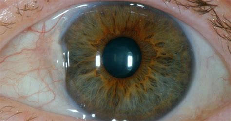 White Spot On Conjunctiva