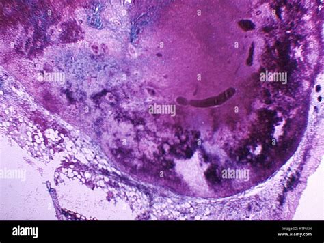 Severe Hemorrhagic Necrosis Of Lymph Node Due To Anthrax Photomicrograph Of Mediastinal Lymph