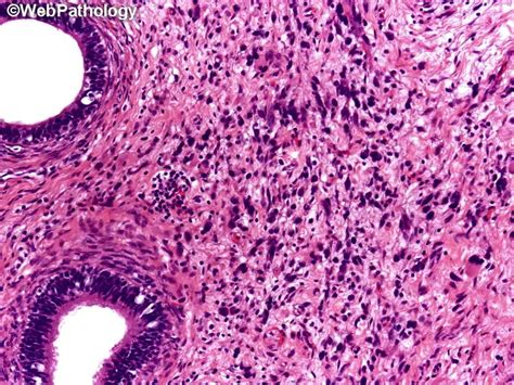 Embryonal Rhabdomyosarcoma Molecular Genetics