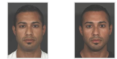 Masseter Reduction Facial Slimming In Winter Park Fl Md Age Management