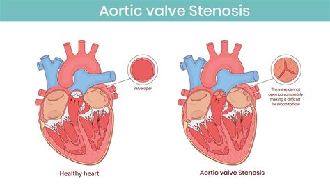 Aortic Stenosis Causes And Treatment