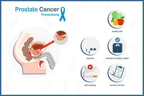 Vector Medical Illustration In Flat Style Prostate Cancer Concept