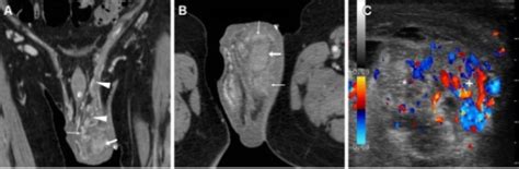 Epididymitis Wikem