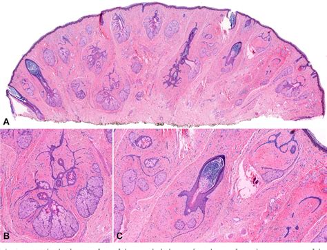 Multiple Fibrofolliculomas Within A Fibrous Cephalic Plaque In A