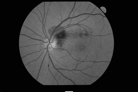 Retinal Macroaneurysm Retina Tree