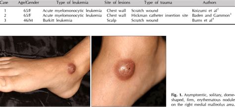 Reported Cases Of Leukemia Cutis At Trauma Sites In Patients With