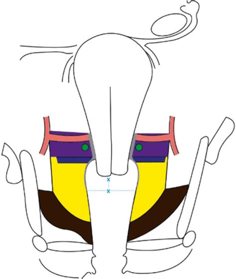 Understanding The Limits Of Parametrial Resection In Radical Hysterectomy A Randomized