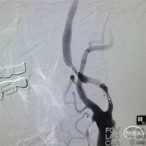缝闭生辉丨proglide血管缝合器在神经介入手术中的应用 脑医汇