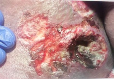 Infected Abscess On The Back Of My Thigh Rpopping