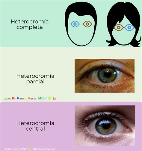 Ems Solutions International Heterocromia