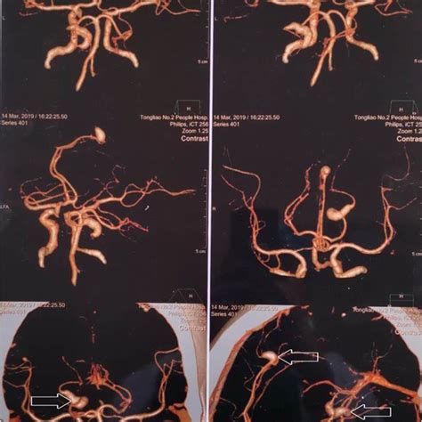 Two Fusiform Aneurysms Located In Left Anterior Cerebral Artery And
