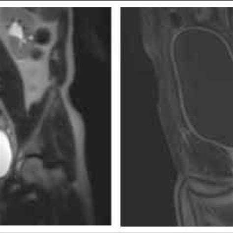 Flexible Cystoscopy Revealed Prostatic Hyperplasia And A Polypoidal Download Scientific Diagram