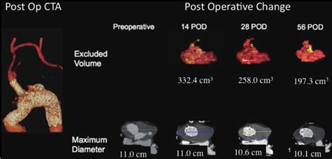Volumetric Analysis Of Excluded Aneurysm Postoperative Ct Angiography