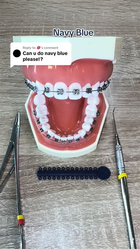 Navy Blue Braces Stylish Color Ideas For Your Treatment Tiktok