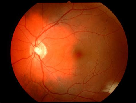 Classification Criteria For Vogt Koyanagi Harada Disease Ento Key