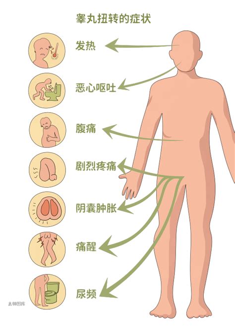 睾丸扭转 医学插画