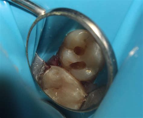 Upper Third Molar Operative Tips Myzerodonto