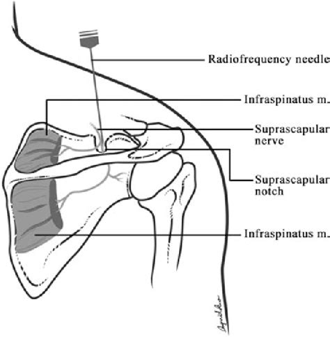 Structure Of Suprascapular Nerve Semantic Scholar