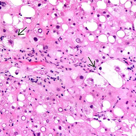Nonalcoholic Steatohepatitis Basicmedical Key