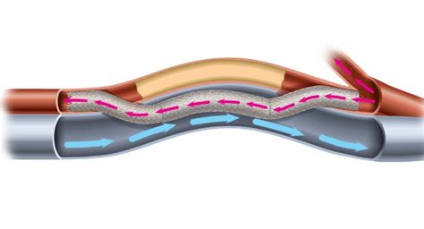 Pq Bypass Earns Breakthrough Designation For Fully Percutaneous Femoral
