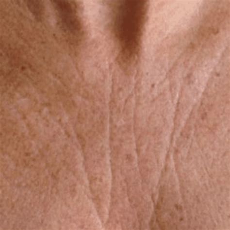 Chest Lines Unveiled Causes And Effective Treatment Options Explored