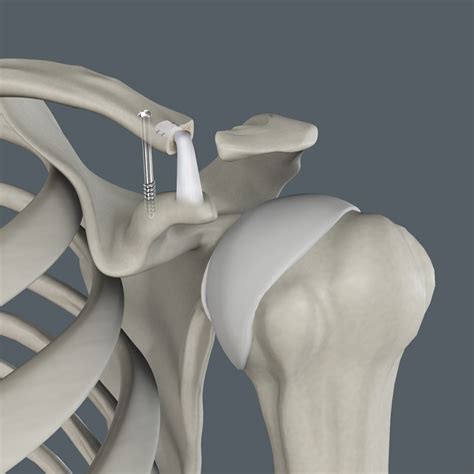 Shoulder Replacement Frisco Tx Shoulder Arthroscopy Frisco Tx