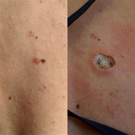 Biopsy Mole Root Question Rmelanoma