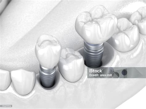Premolar And Molar Tooth Crown Installation Over Implant White Concept