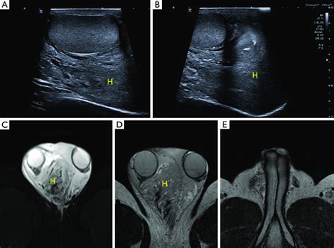 Penile Fracture X Ray