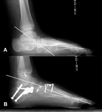 Medial Calcaneal Osteotomy