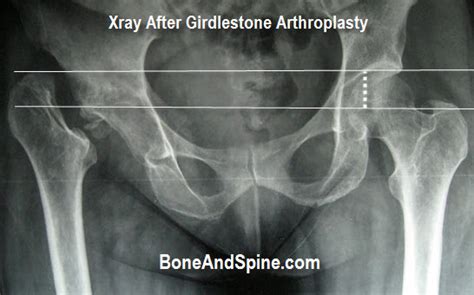 Girdlestone Procedure Icd 10 Pcs Lalecu