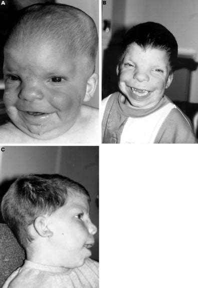 A B C Front And Side View Of Case 2 Aged 7 Months And 5 Years