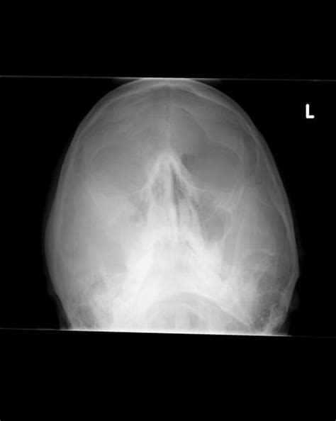 Fibrous Dysplasia Face Radiopaedia