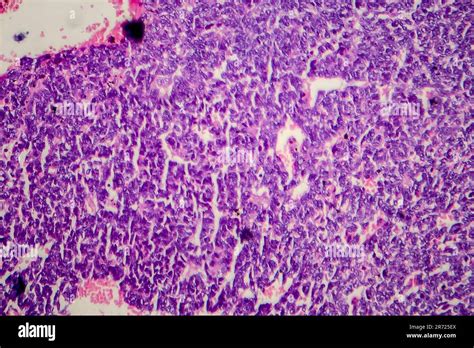 Wilms Tumor Or Nephroblastoma Light Micrograph Photo Under