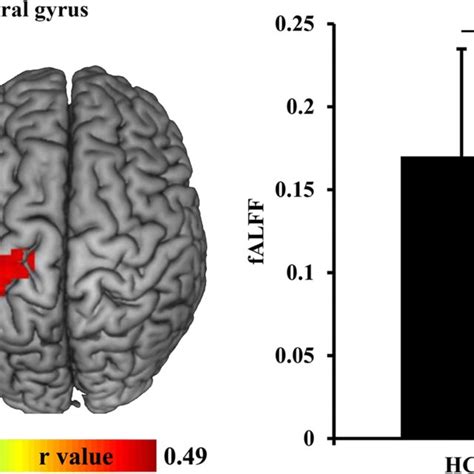 The Tract Based Spatial Statistics Tbss Analysis Identified Download Scientific Diagram