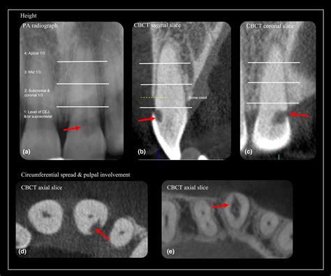 External Cervical Resorption A Three‐dimensional Classification