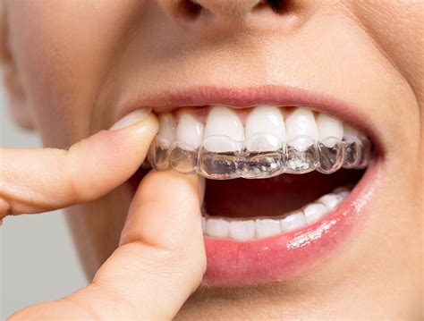 Tipos De Braces Dr Jose Vicens
