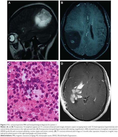Successful Treatment With Apatinib For Refractory Recurrent Malignant Ott