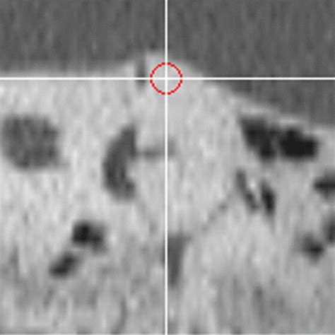 In The Temporal Bone Ct Measurements Were Taken From The Bone Download Scientific Diagram