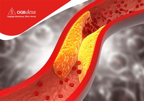 Pentingnya Pencapaian Target Terapi Dislipidemia Untuk Menyelamatkan