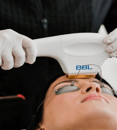 Broadband Light Bbl Laser Treatments Signature Medispa