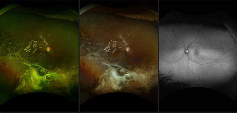 California Acute Retinal Necrosis With Repaired Rd Pvr Cme And