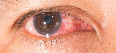 Tipos De Queratitis ¡conócelos Todos Área Oftalmológica