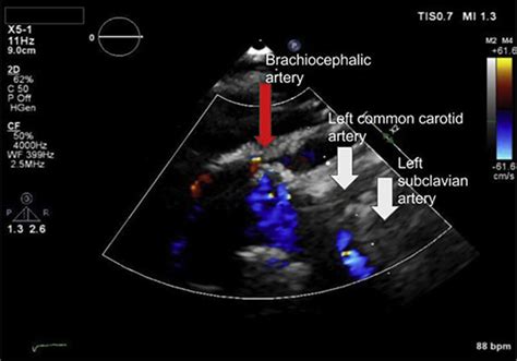 The Use Of Transthoracic Echocardiography In Diagnosing Brachiocephalic